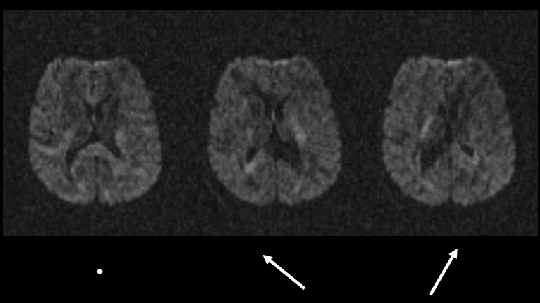 Diffusion Imaging and Fibre Tractography