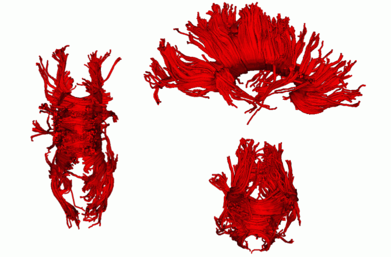 Diffusion Imaging and Fibre Tractography