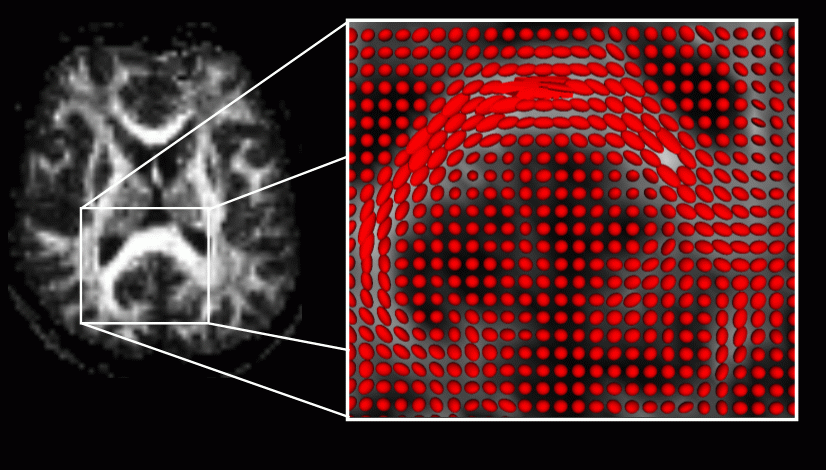 Diffusion Imaging and Fibre Tractography